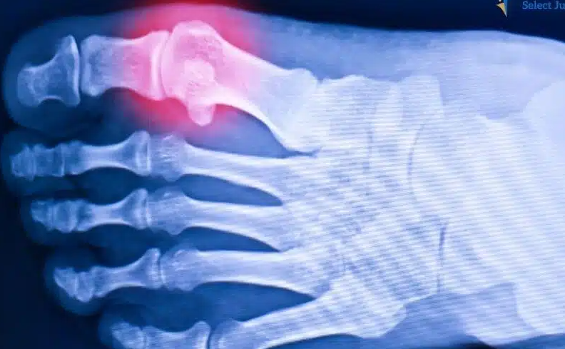 Cartiva implant Lawsuit [Updated] - LawGud